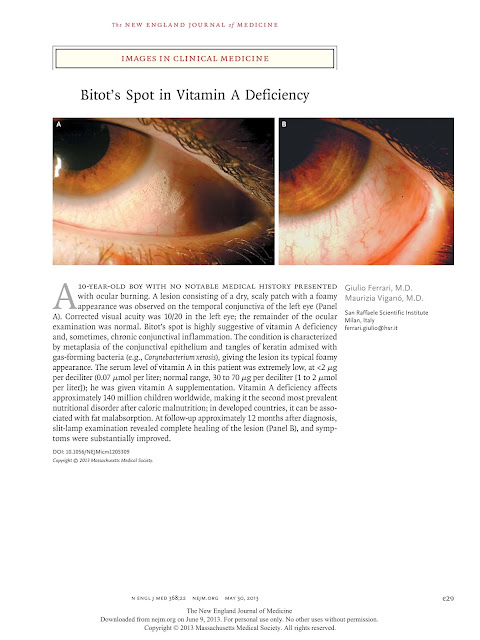 HÌNH ẢNH LÂM SÀNG VÀ CHẨN ĐOÁN HÌNH ẢNH: Bitot's Spot in Vitamin A ...