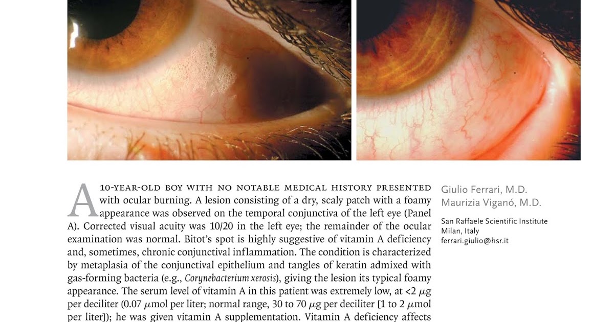 HÌNH ẢNH LÂM SÀNG VÀ CHẨN ĐOÁN HÌNH ẢNH: Bitot's Spot in Vitamin A ...