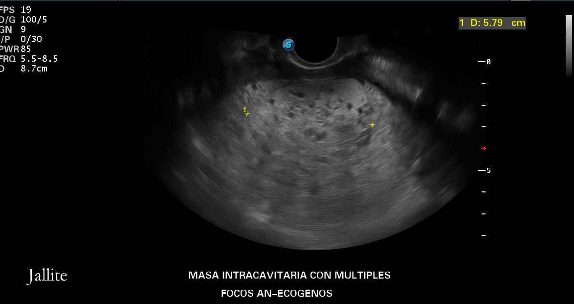 Mola Hidatiforme Total
