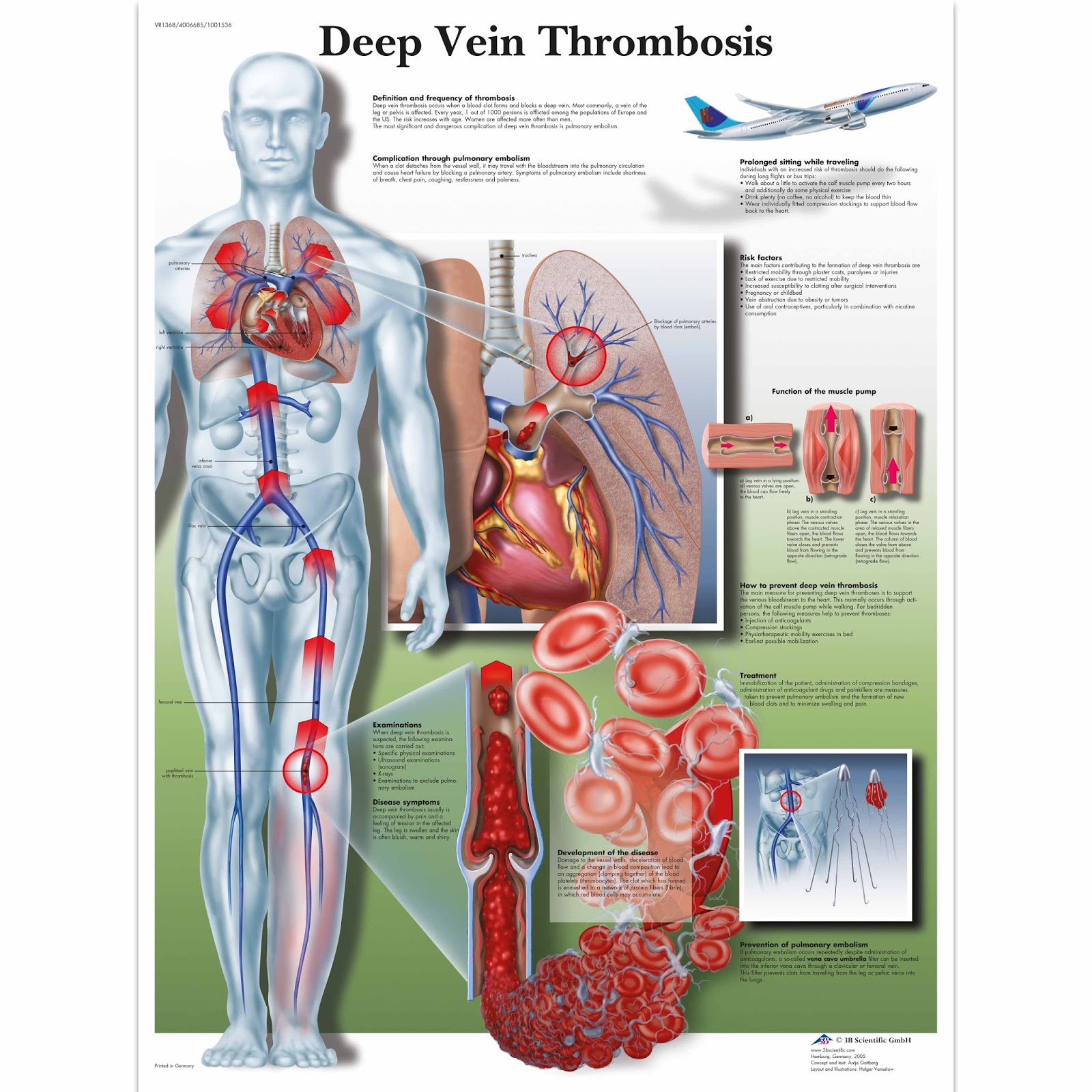 VASTRAL PHYSIOTHERAPY CLINIC: DEEP VEIN THROMBOSIS : OVERVIEW & TREATMENT