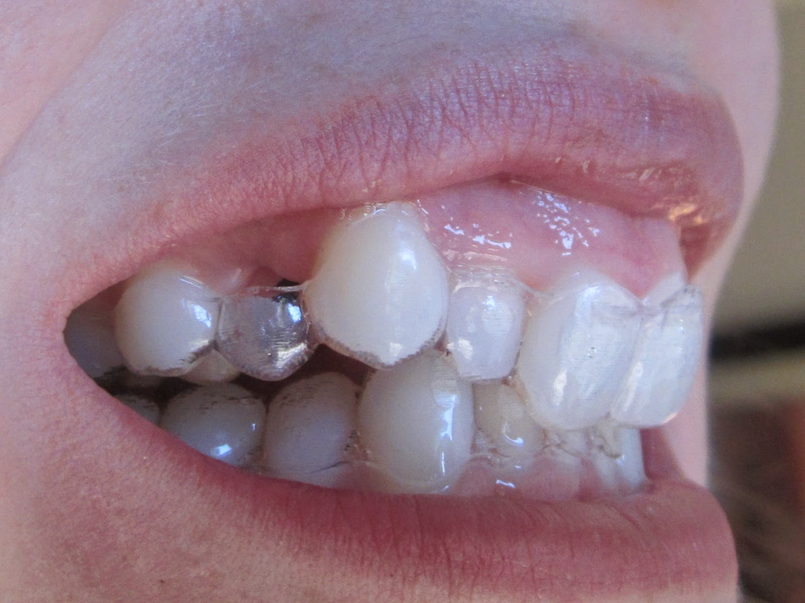 Creatively Titled Blog about Invisalign: Tray Two!