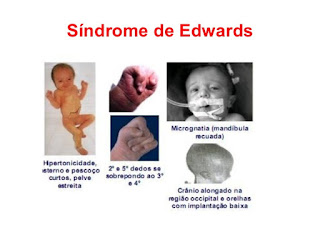 estomatologia: ¿¿¿SABES QUE ES EL SÍNDROME DE EDWARDS???