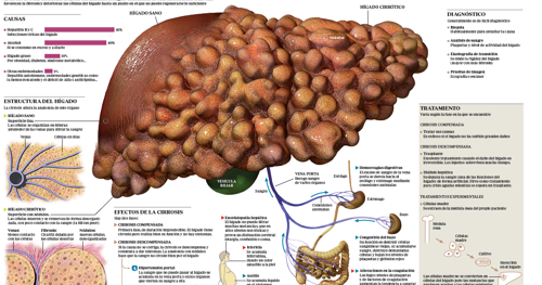 Kevin Moreno Cirrosis Hepática Hablemos De La Cirrosis HepÁtica ¿quÉ Es