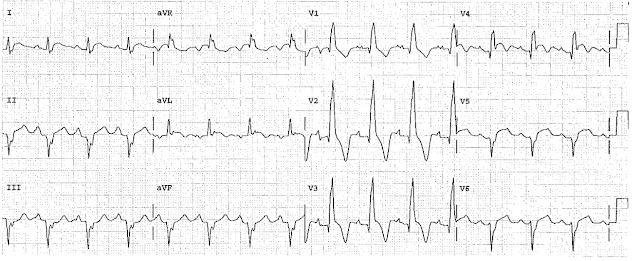 EM Didactic: The "qRBBB" pattern