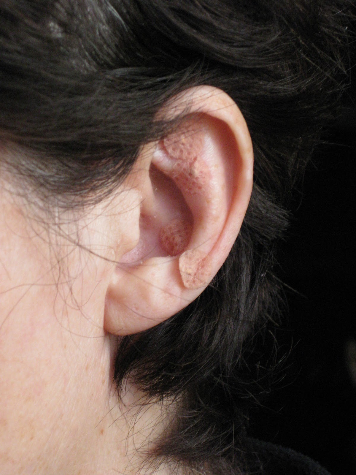 Gills RSD (CRPS): DOWNHILL DECEMBER