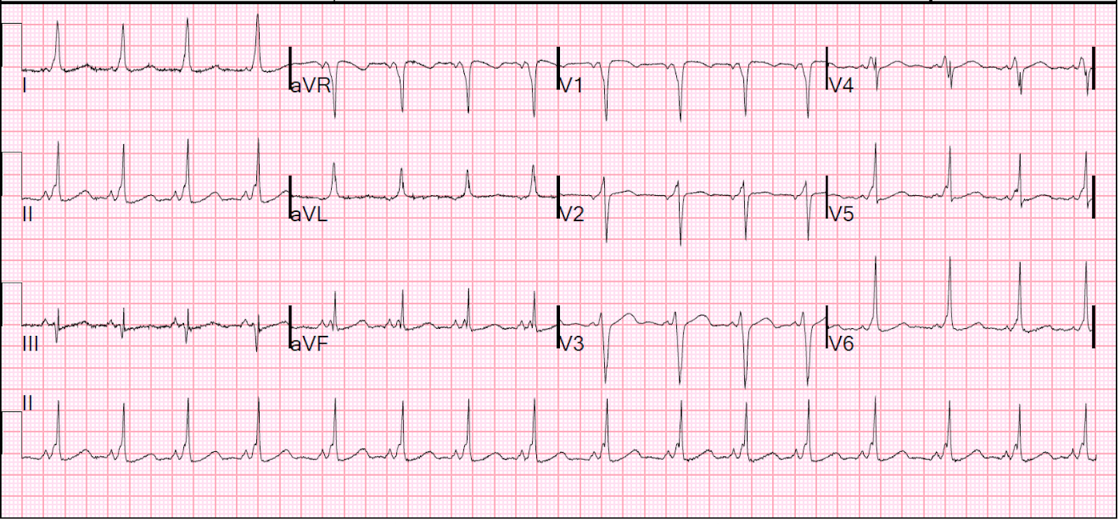 Dr Smith s ECG Blog 12 Year Old Asthmatic With Intermittent Dyspnea dr-smith-s-ecg-blog-12-year-old-asthmatic-with-intermittent-dyspnea