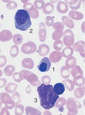 [Haematology] Abnormalities of the White Cell Series | Free Medical Atlas