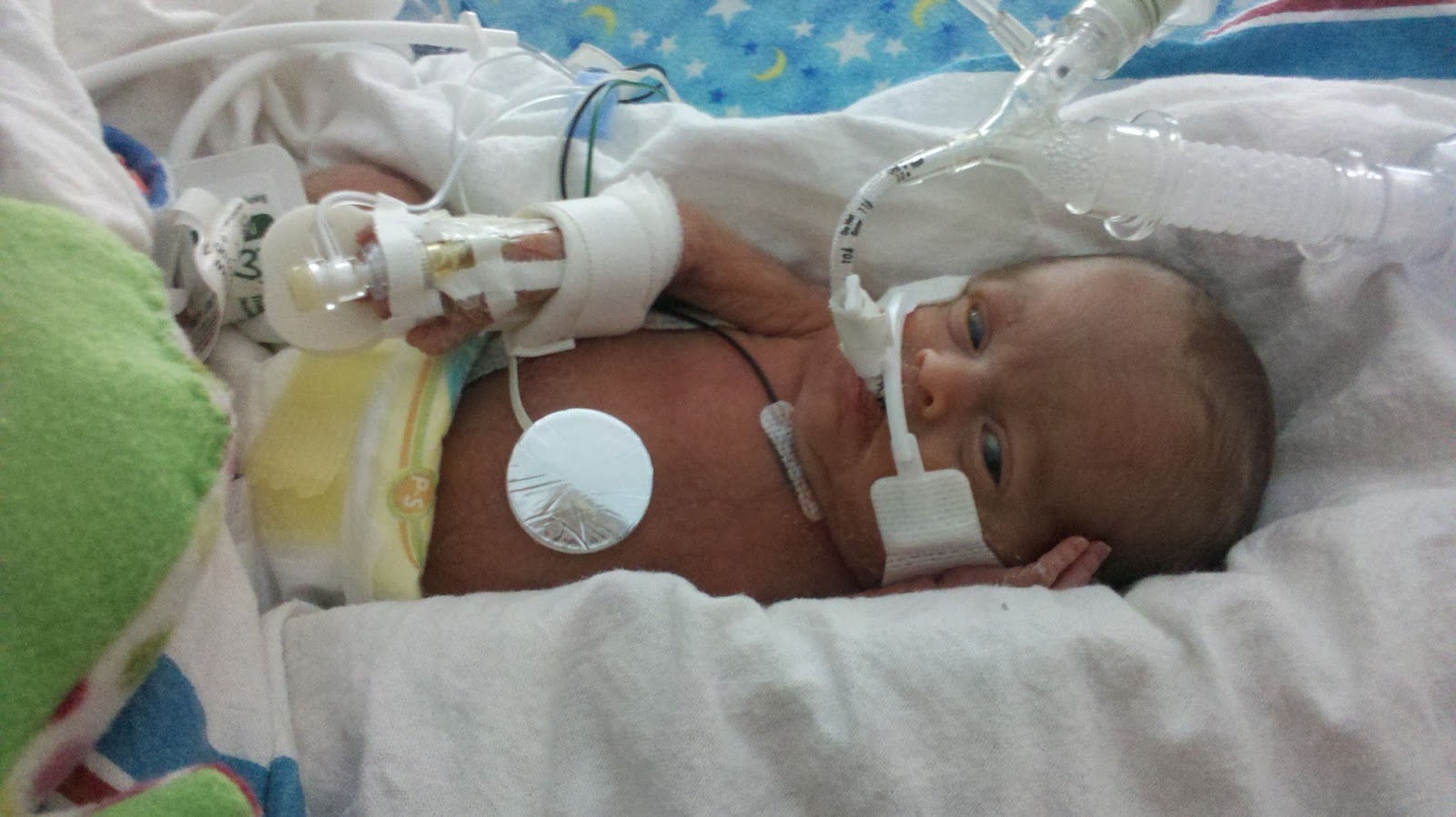 JAM sessions: Lessons learned through a micro-preemie: Day 40 & 41 ...