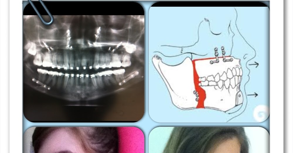 A Guide to Surviving Orthognathic Surgery: Before and After Jaw Surgery ...