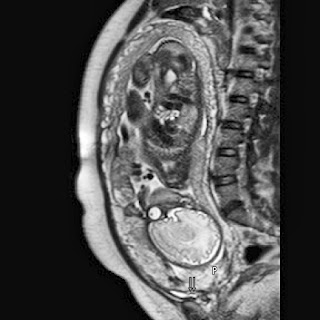 The Well-Rounded Mama: Placenta Accreta, Part Four: Diagnosis ...