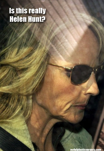 Helen Hunt Plastic Surgery Before and After | Plastic Surgery