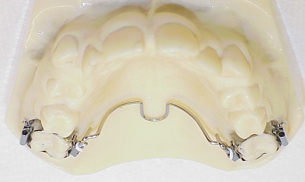 Beugelbekkie: Bandjes om me kiezen