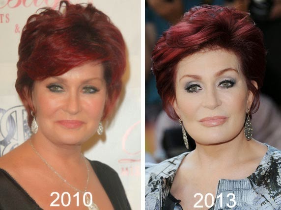 Teriti: Sharon Osbourne Plastic Surgery Before & After