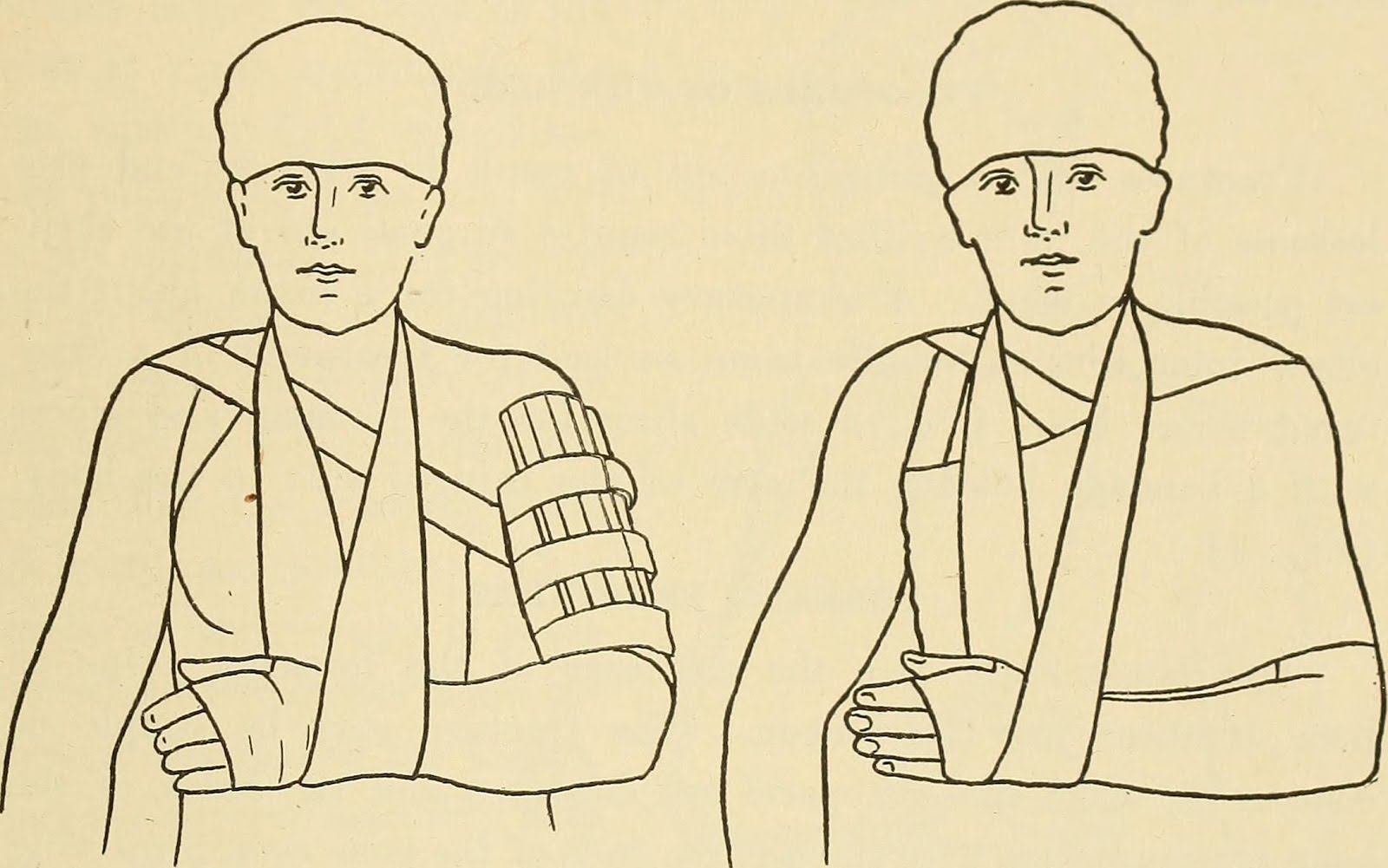 Simple Fracture - Treatment | First Aid Steps | Healing Time