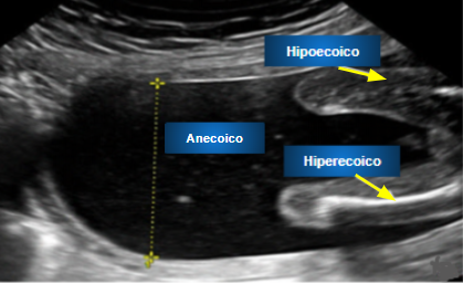 ¿Cómo interpretar una ecografía?