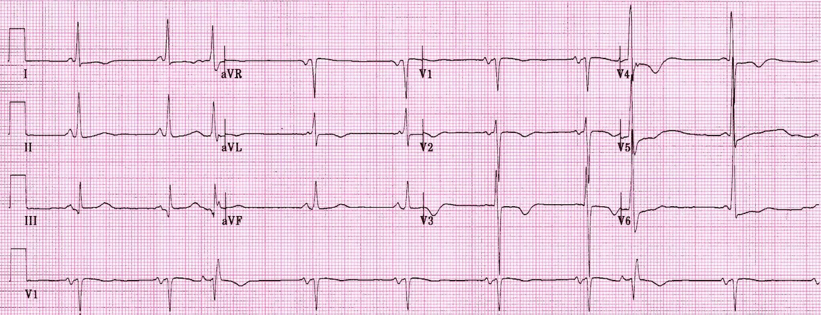 Study Medical Photos: Ashman Phenomenon - ECG