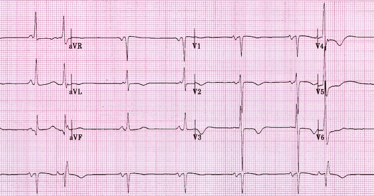 Study Medical Photos: Ashman Phenomenon - ECG