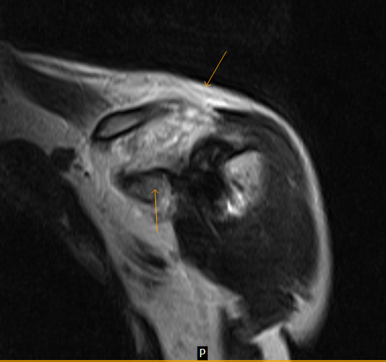 AC Joint Disruption MRI - Sumer's Radiology Blog