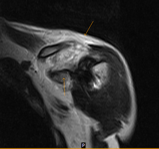 AC Joint Disruption MRI - Sumer's Radiology Blog