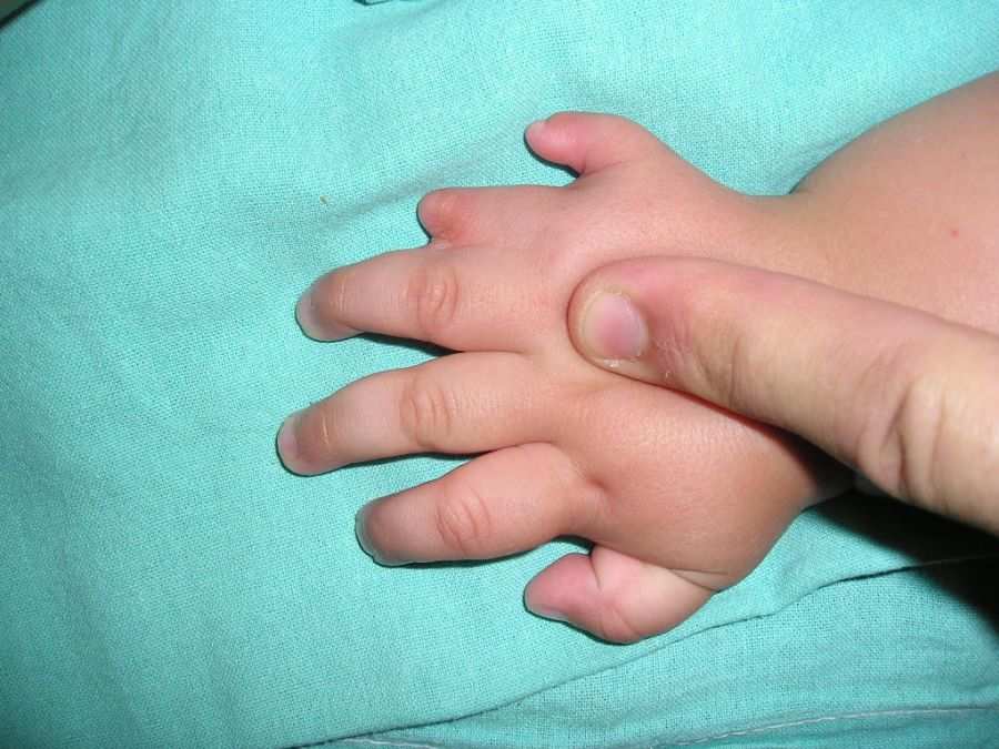 Sobre técnicas de imágenes médicas (Blog STIM): Polidactilia