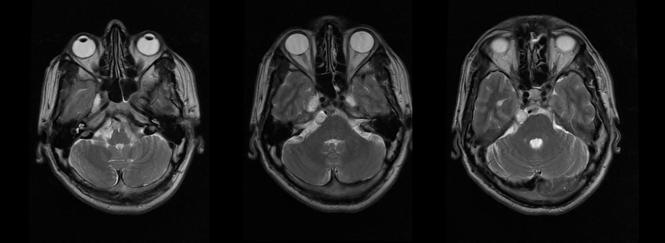 Dr Balaji Anvekar's Neuroradiology Cases: Meckel's Cave Lipoma MRI