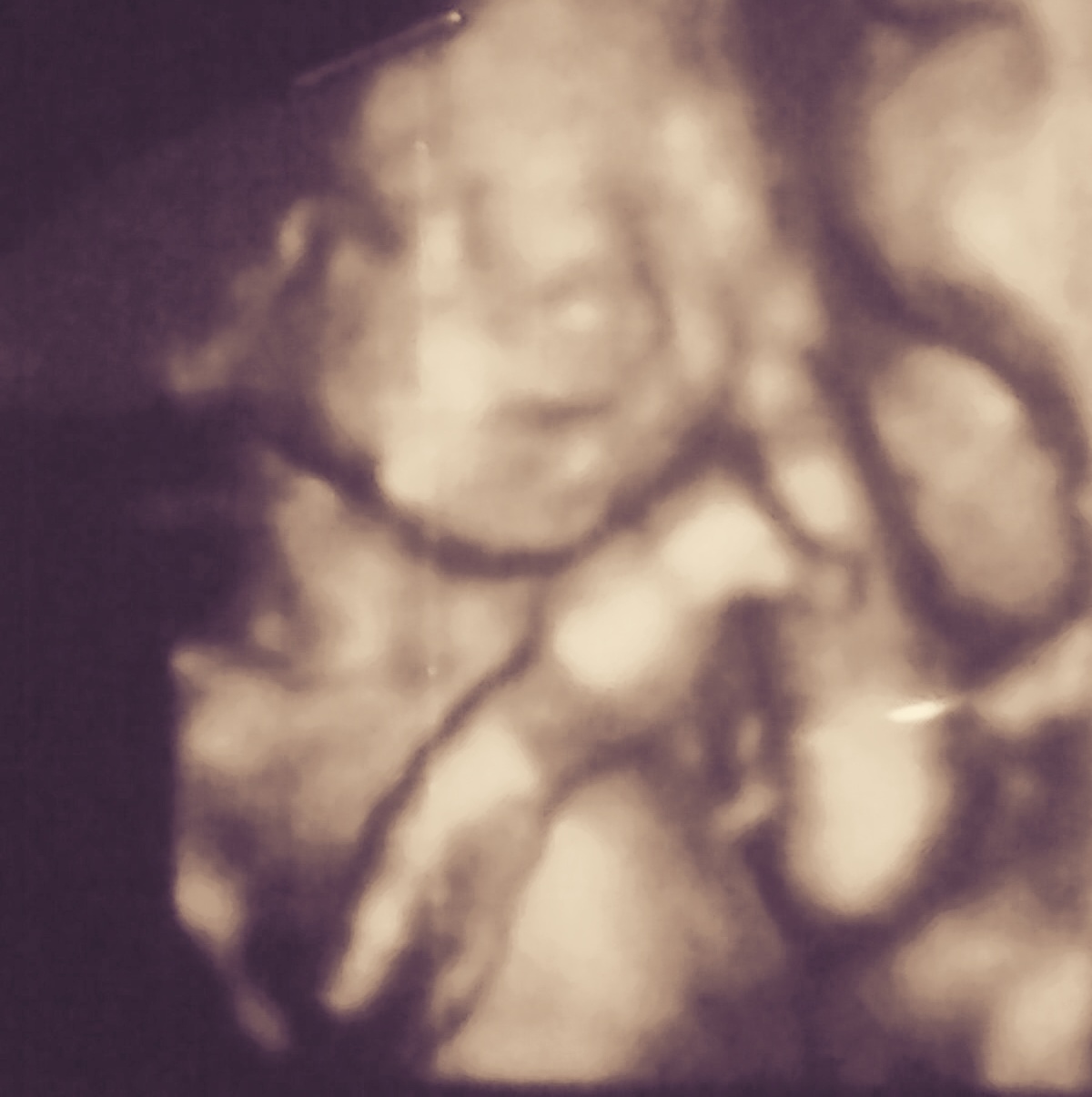 CARA MEMBACA HASIL USG | Rainbownight_artYASA