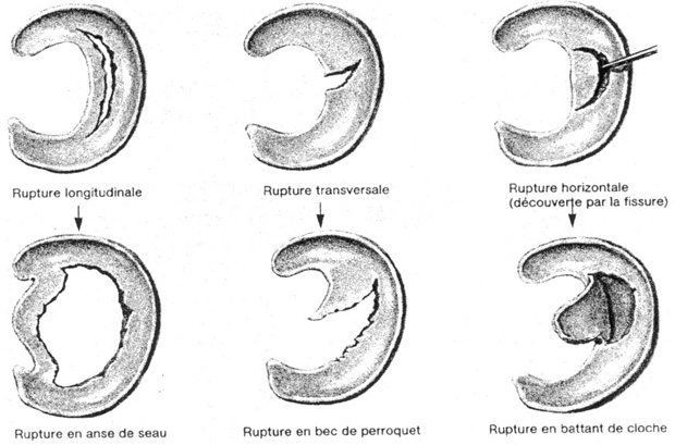 Alila Medical Media Types De Lesions De Menisque Illustration Medicale ...