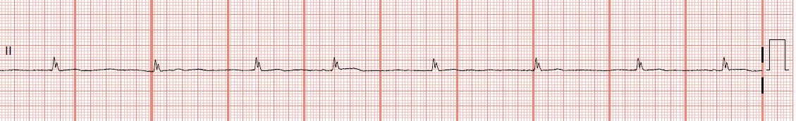 EKG Rhythm Strips 43
