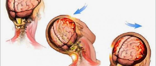 Traumatismo Crânio Encefálico (TCE) | Enfermagem