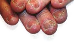 The Naily Guide To Flaws And Fungus: Onychophagy