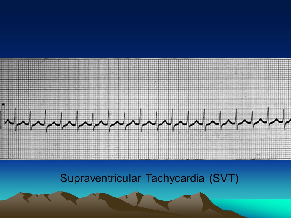 CVT Mohd Farid: Electrocardiogram ECG Part III Basic ECG Rhythm Pattern ...