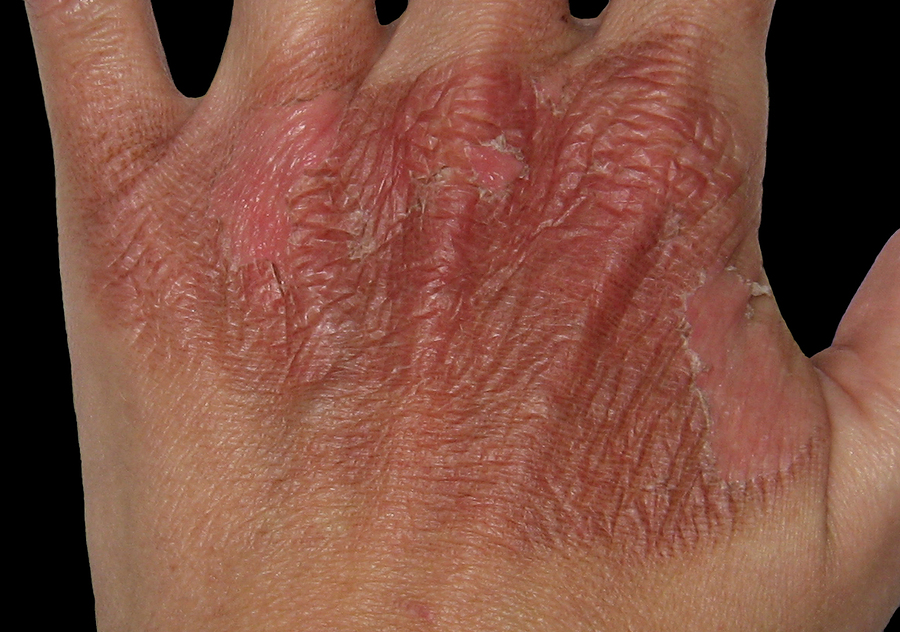 FMS408GothicHorrorSalmonM: Burns - Coloration and Degrees