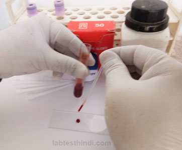 Sickle Cell क्या है | Sickling Test कैसे करते है – ( Slide Method ...