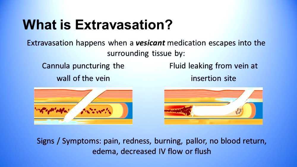 Extravasation Cancer