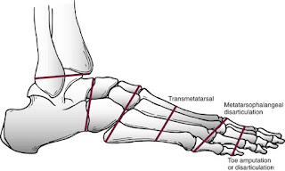 Transmetatarsal amputation Pictures, Rehabilitation, Recovery ...