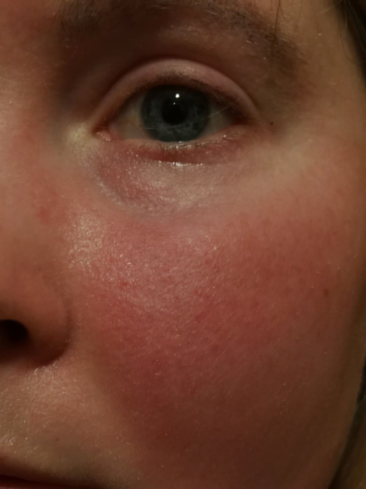 Scarlet Letters, dealing with vascular rosacea, face flushing, burning ...