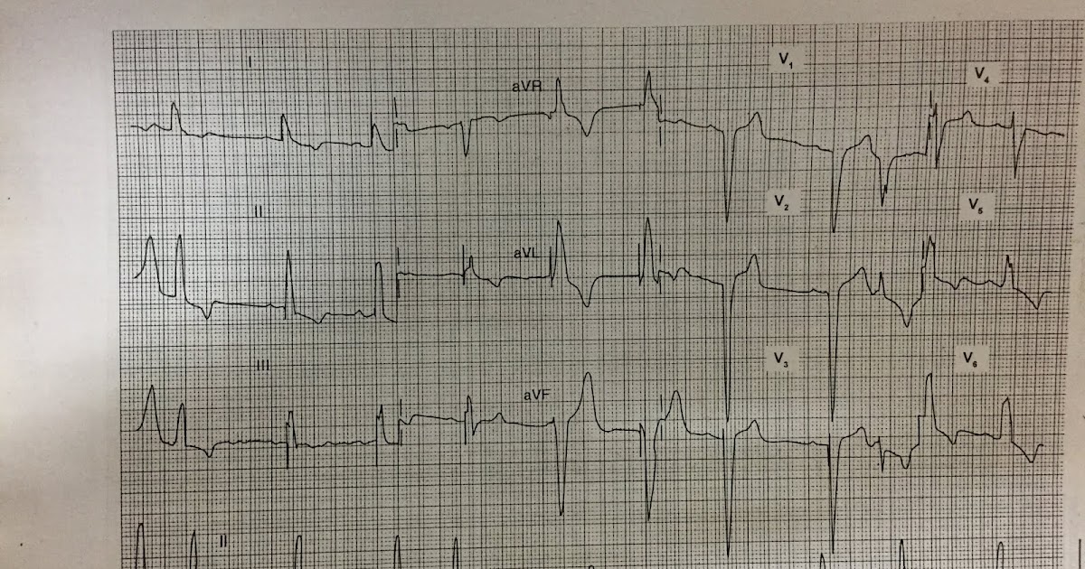 ECG EXERCISE 3,4