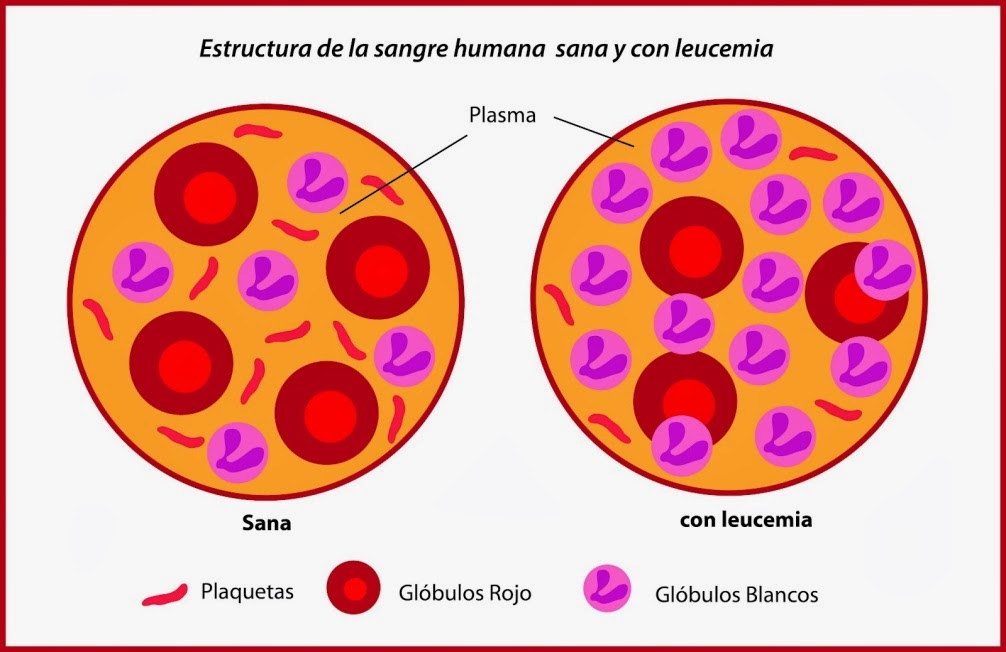 Monografia: La Leucemia