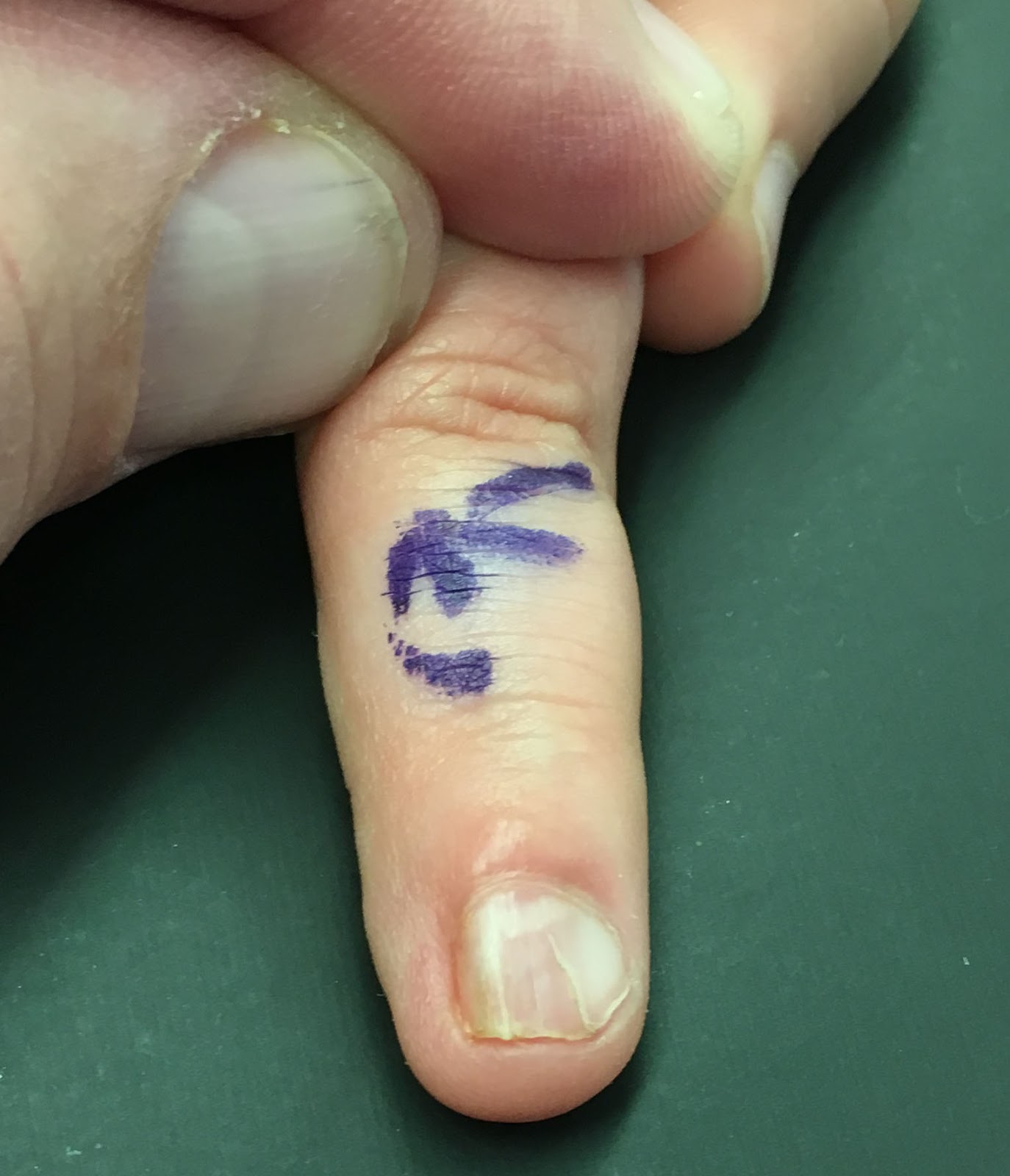 Fingernail Bump Congenital Hand And Arm Differences fingernail-bump-congenital-hand-and-arm-differences