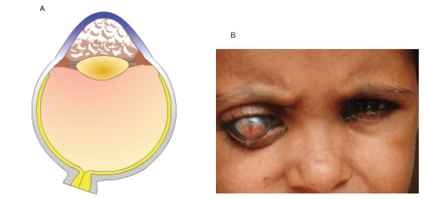 Ophthalmology | Ophthalmologist: CORNEAL OPACITIES
