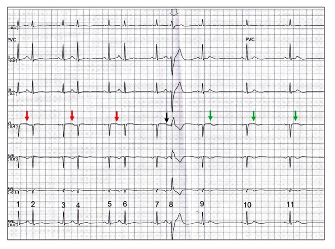 ECG Rhythms: Aberrancy