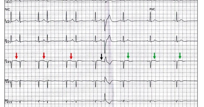 ECG Rhythms: Aberrancy