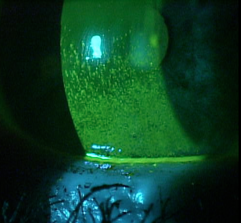 Dry Eye Relief Without A Prescription: The Science Behind Retaine MGD ...