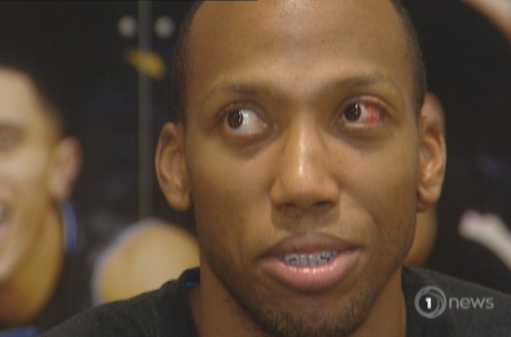 Welcome to Olamama's blog!!!: Basketball player’s eye pops out of its ...