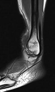RADIODIAGNOSIS - IMAGE COLLECTION: STRESS FRACTURE OF FIBULA
