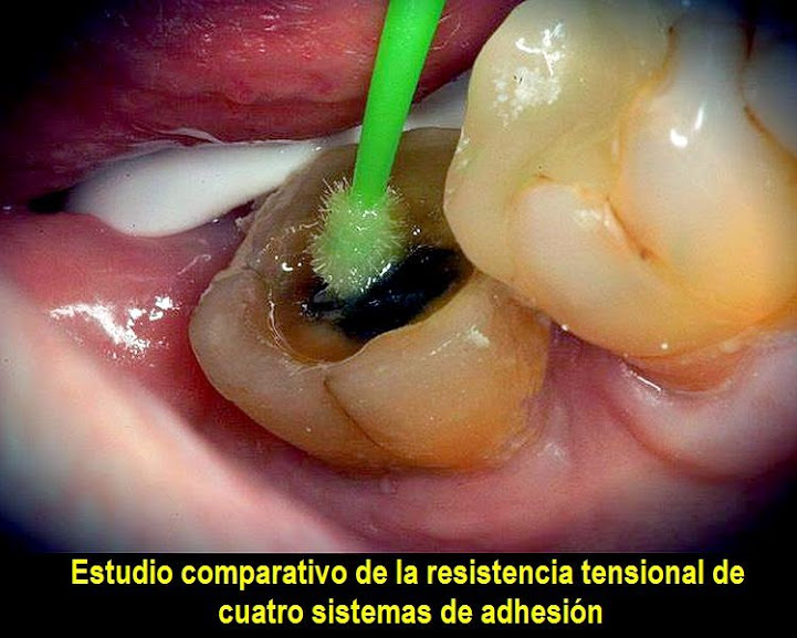 ADHESIÓN DENTAL: Estudio comparativo de la resistencia tensional de 4 ...