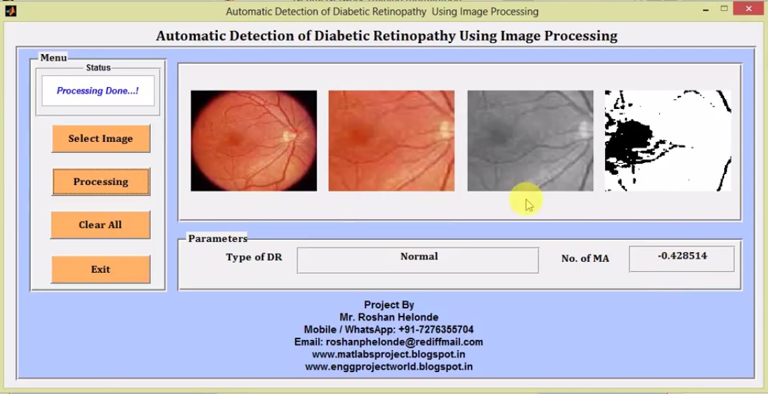 Detection Of Diabetic Retinopathy In Fundus Images Using Neural Network Matlab Project With 9241