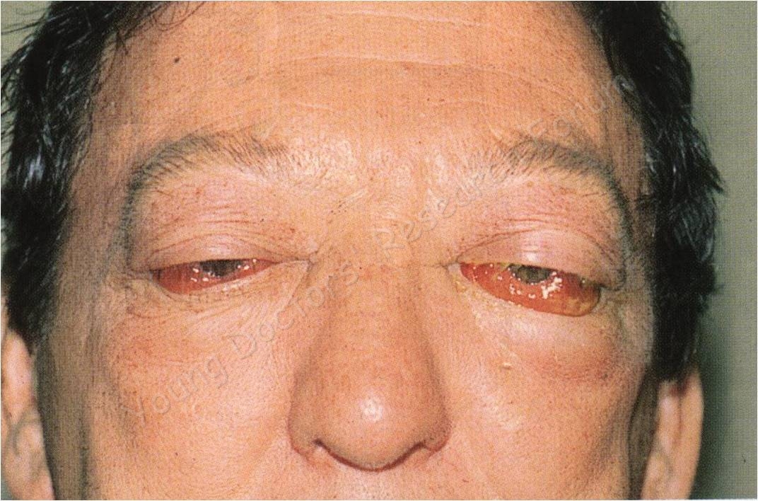 Photos For Chemosis ~ YOUNG DOCTORS' RESEARCH FORUM