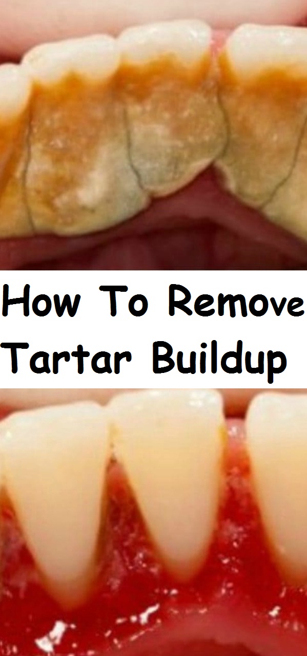 How To Remove Tartar Buildup - my tips favorite