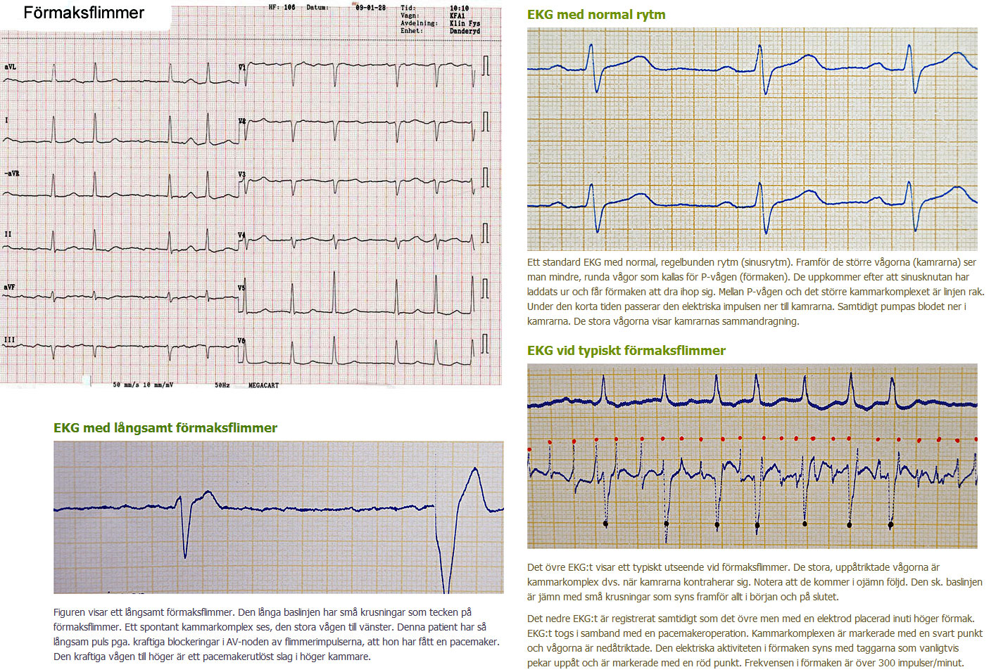 .: Förmaksflimmer - en folksjukdom?